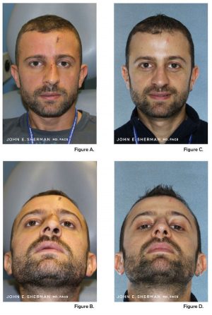 Best Nasal Fracture Treatment NYC | Dr. John E. Sherman